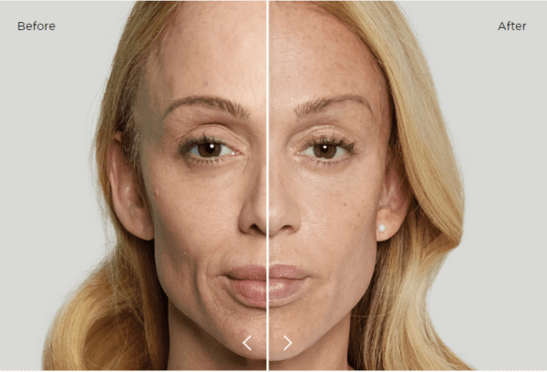 Fotos Antes e Depois | Liftera, Coolfase, Bioestimulador, Profhilo ...