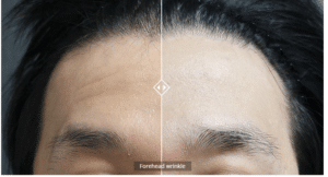 Liftera: Lifting Natural | Como Funciona? Veja o Antes e Depois!