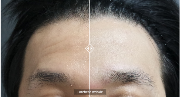 Liftera: Lifting Natural | Como Funciona? Veja o Antes e Depois!