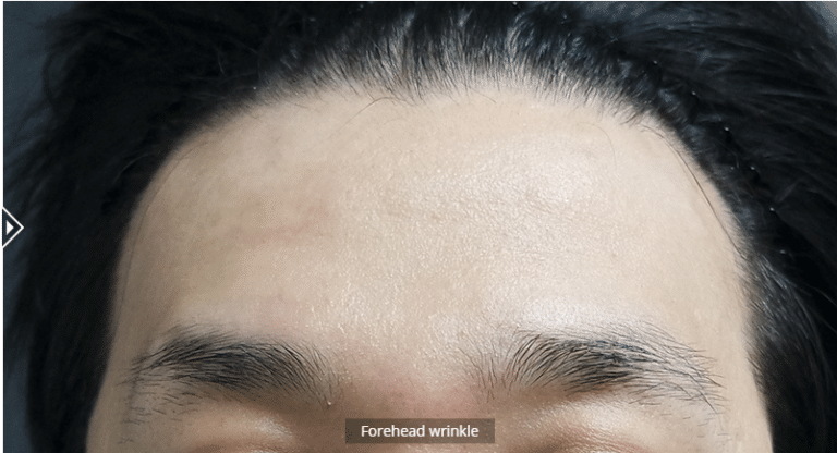 Liftera: Lifting Natural | Como Funciona? Veja o Antes e Depois!