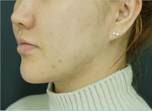 Liftera 2: Lifting Natural | Como Funciona? Veja o Antes e Depois!