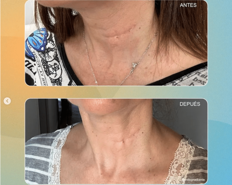 Liftera: Lifting Natural | Como Funciona? Veja o Antes e Depois!