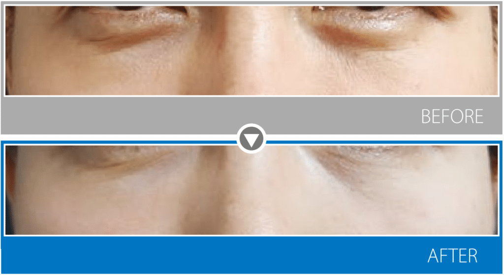 Liftera: Lifting Natural | Como Funciona? Veja o Antes e Depois!