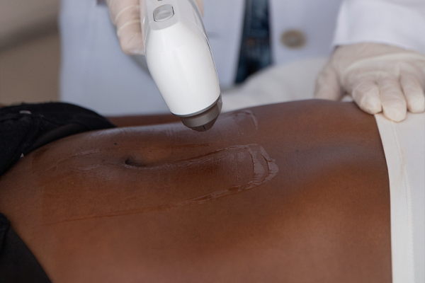 Liftera: Ultrassom Microfocado | RJ | Preço e Qualidade